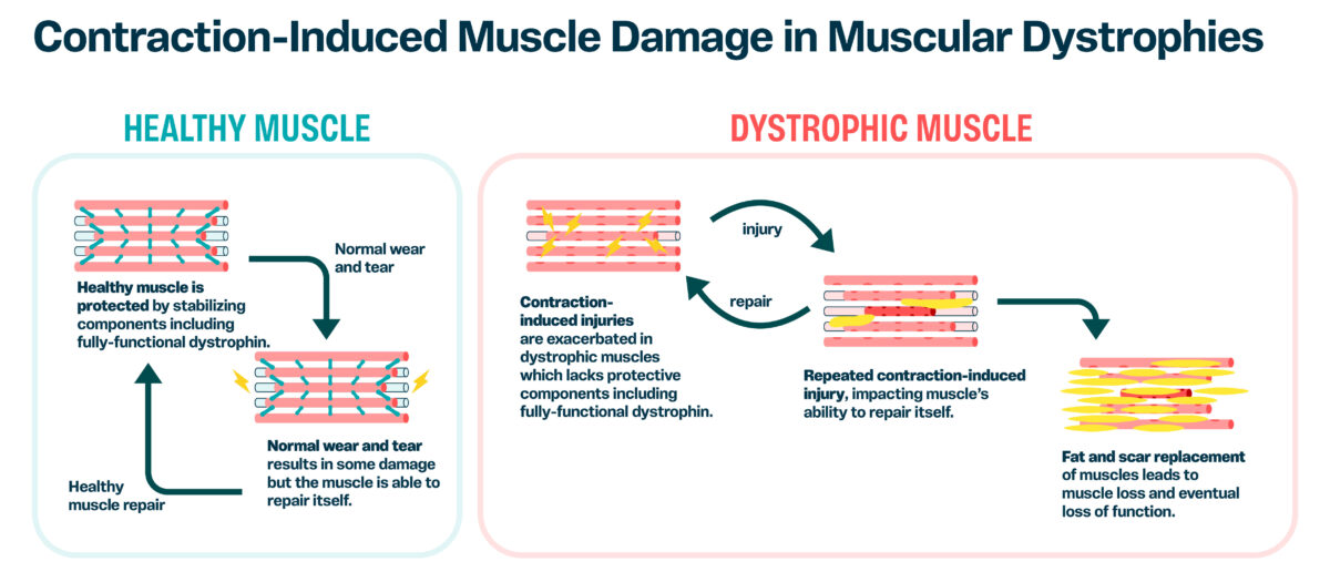 Becker Overview : Becker Muscular Dystrophy